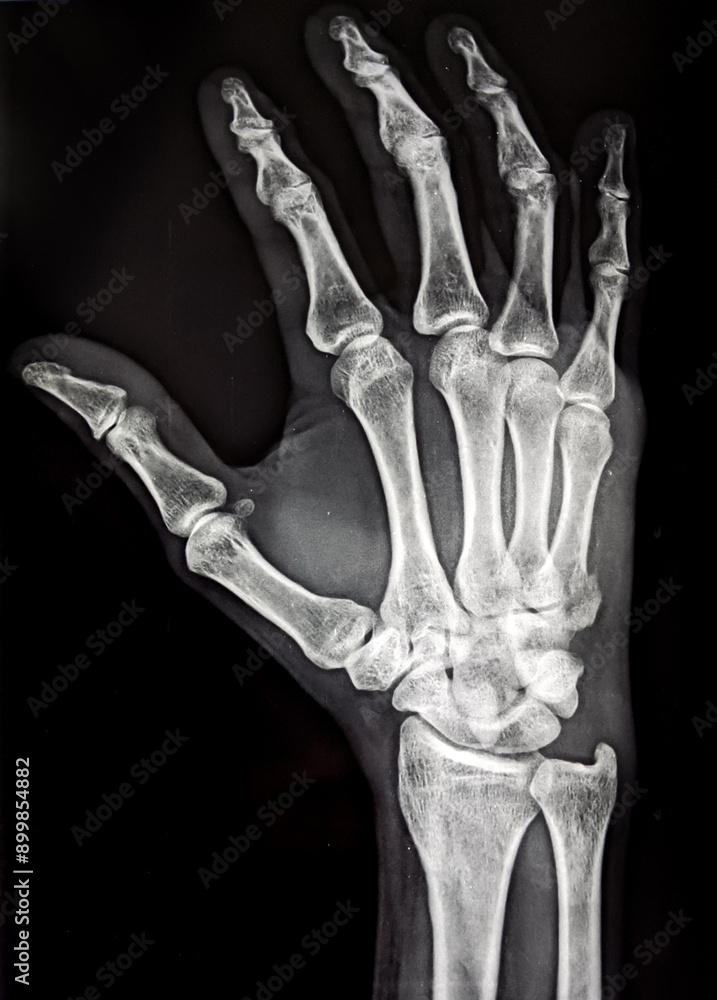 X ray of hand showing fifth metacarpal fracture, a common sports injury ...