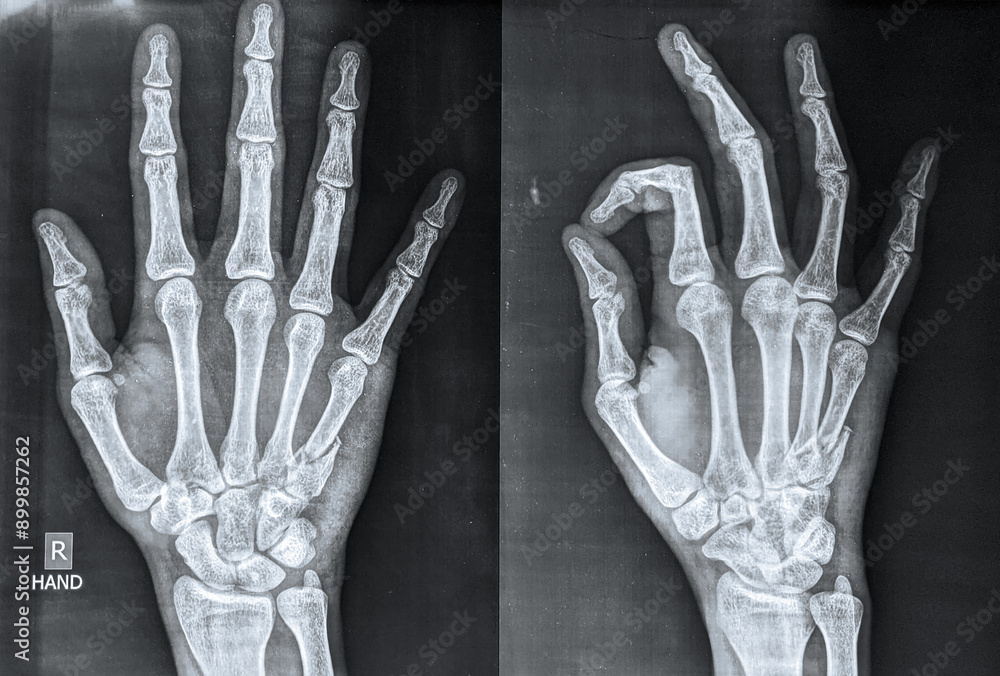 X ray of hand showing fifth metacarpal fracture, a common sports injury ...