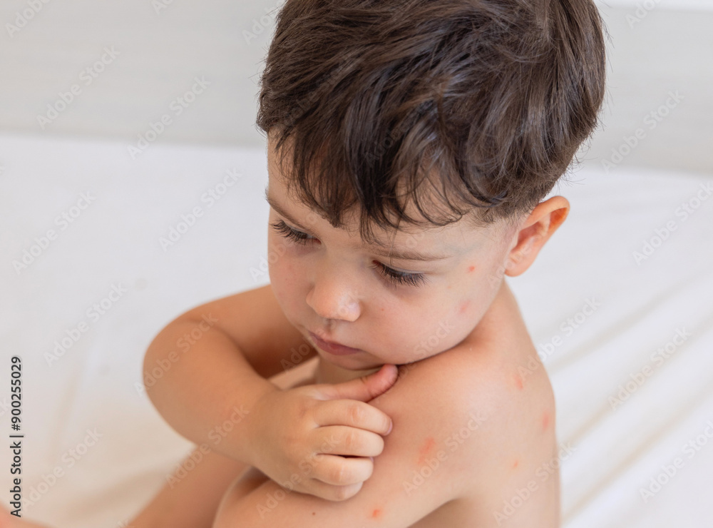 kid back with lot of insects bites,mosquito or fleas, red spots. lying ...