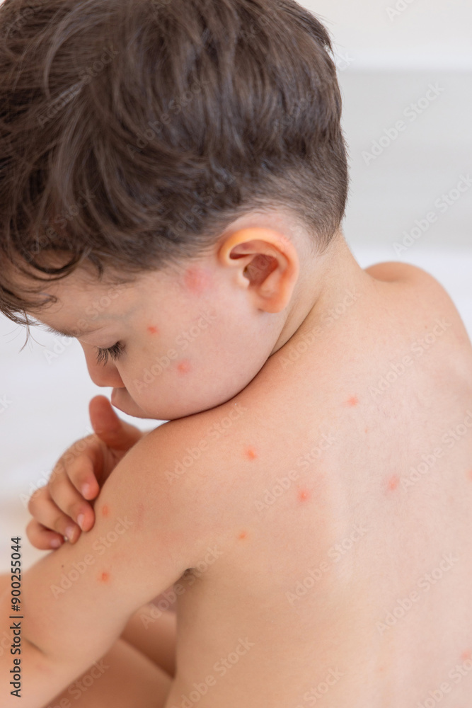 kid back with lot of insects bites,mosquito or fleas, red spots. lying ...
