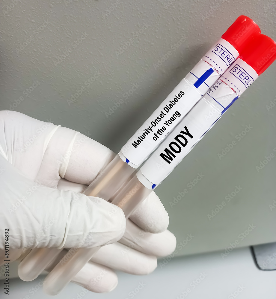 Oral swab sample for MODY or Maturity-Onset Diabetes of the Young test ...