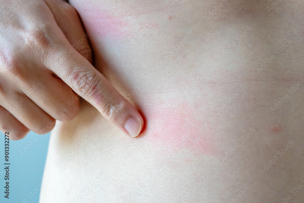 Young asian man itching and scratching on body from allergic itchy dry ...