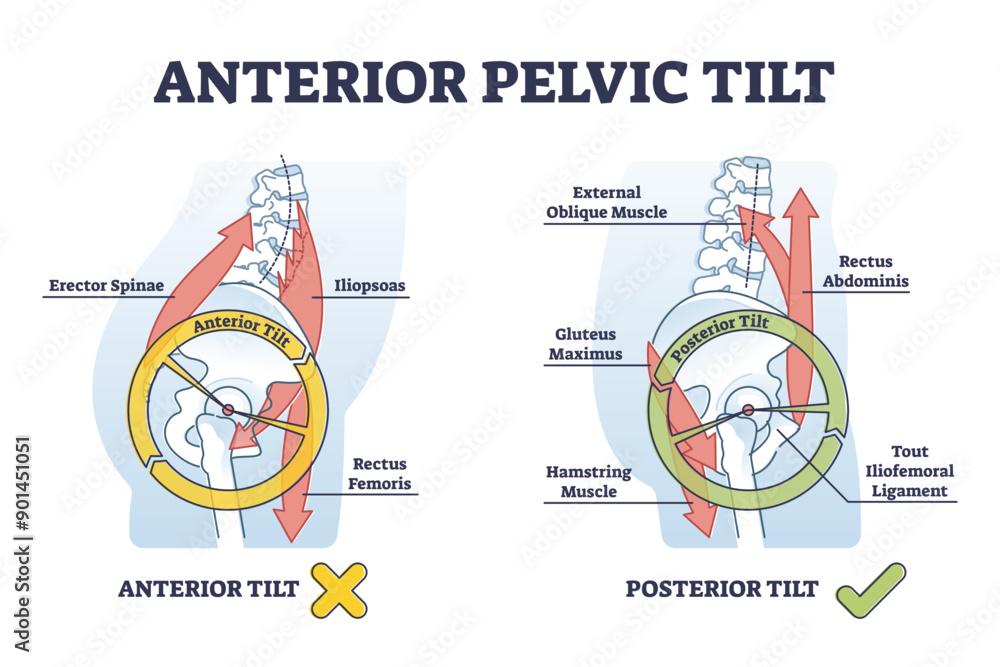 Anterior pelvic tilt model compared with posterior labeled outline ...