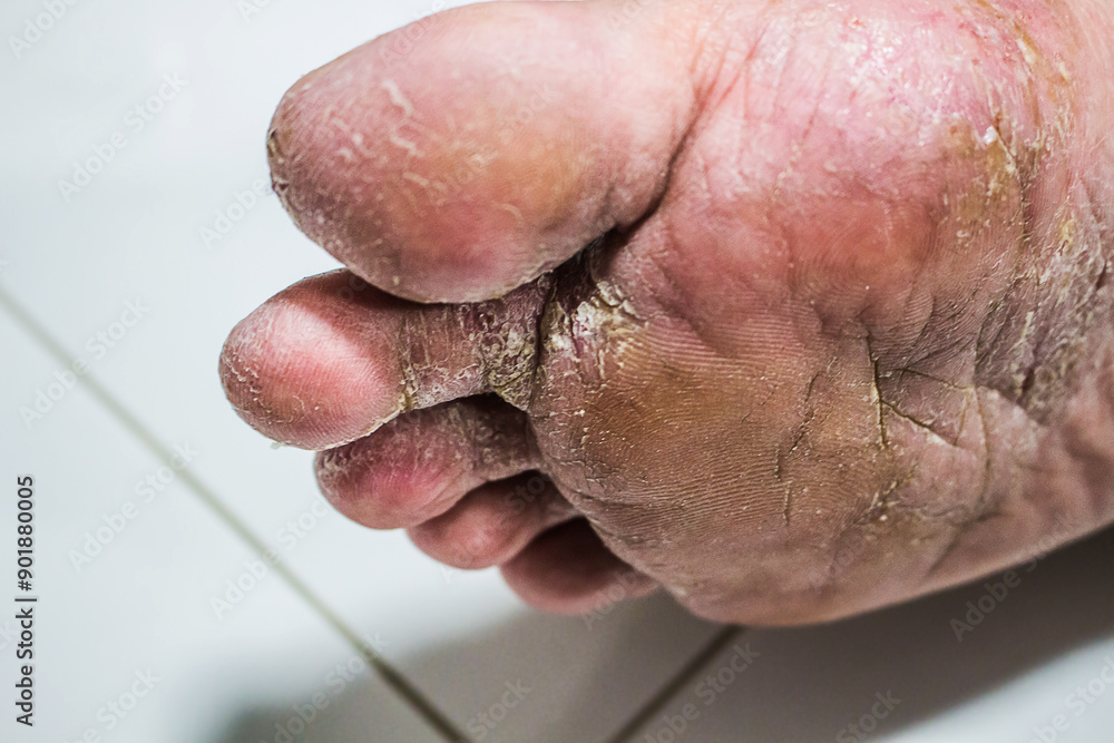 Men's feet with fungus, The skin peels off into wounds, Athlete's Foot ...