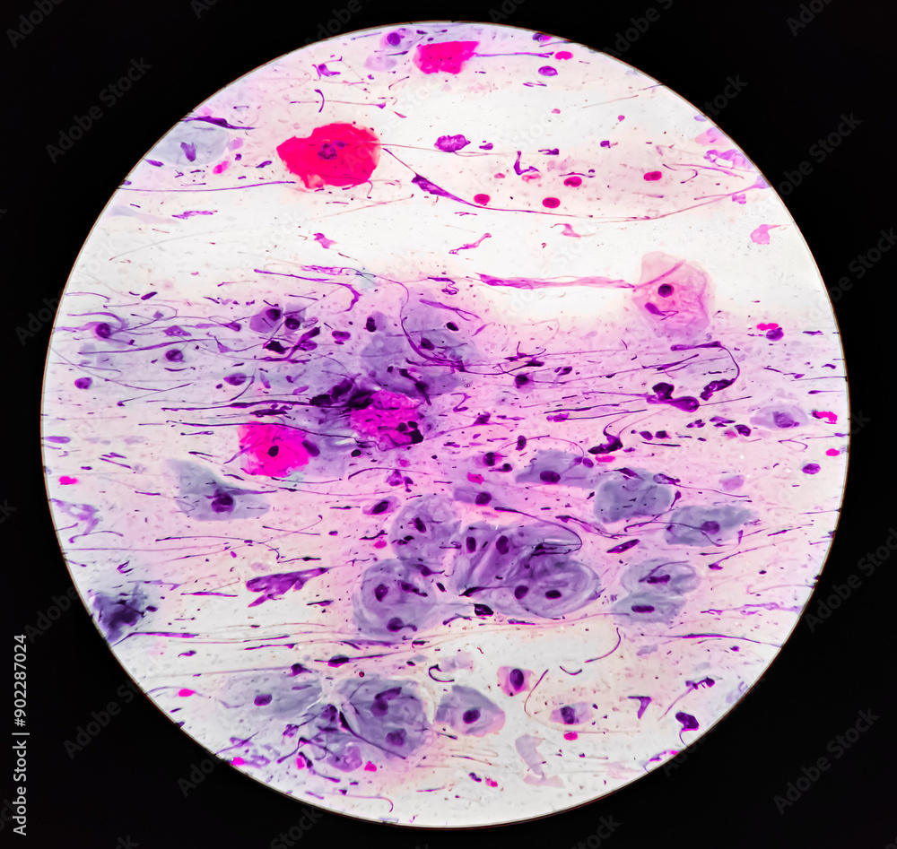 Pap's smear. Inflammatory smear with HPV related changes. Cervical ...
