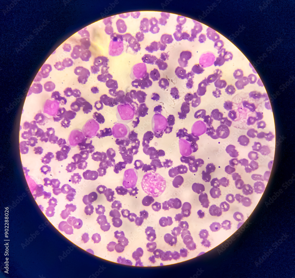 Acute leukemia, ALL(Acute lymphoblastic leukemia), peripheral blood ...