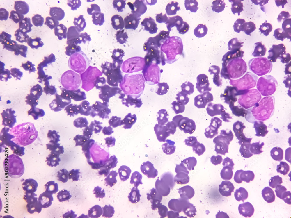 Póster Acute leukemia, ALL(Acute lymphoblastic leukemia), peripheral ...