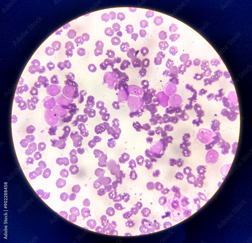 Acute leukemia, ALL(Acute lymphoblastic leukemia), peripheral blood ...