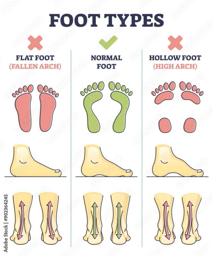 Foot types with flat, normal and hollow feet comparison in outline ...