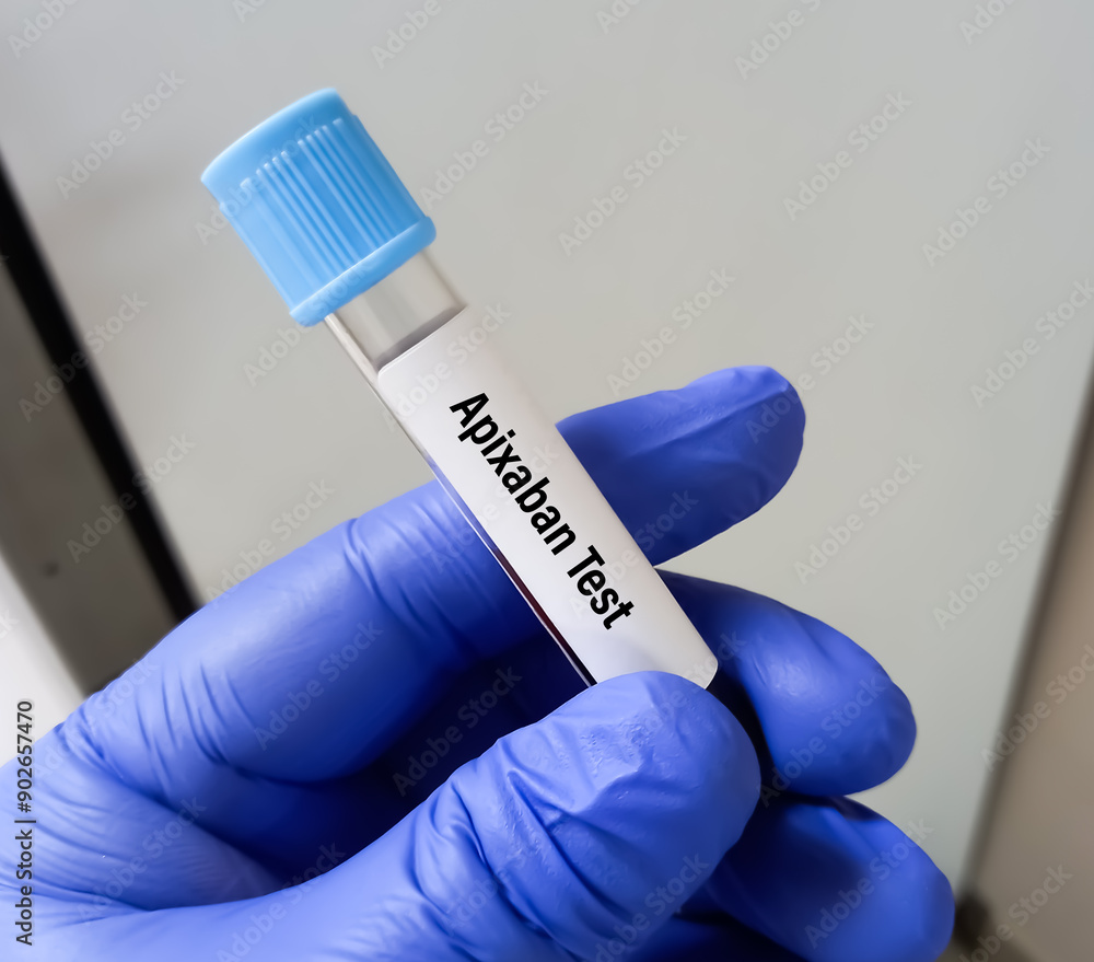 Blood sample for Apixaban level test. Measurement of drug level in ...