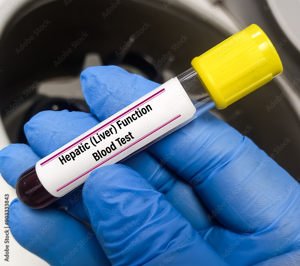 Blood sample for Hepatic Panel test, Liver function test or LFT. Stock ...