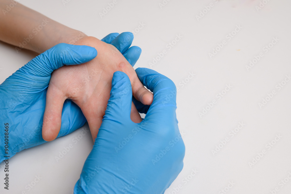 Dermatologist examines children palm affected by viral warts Verruca ...