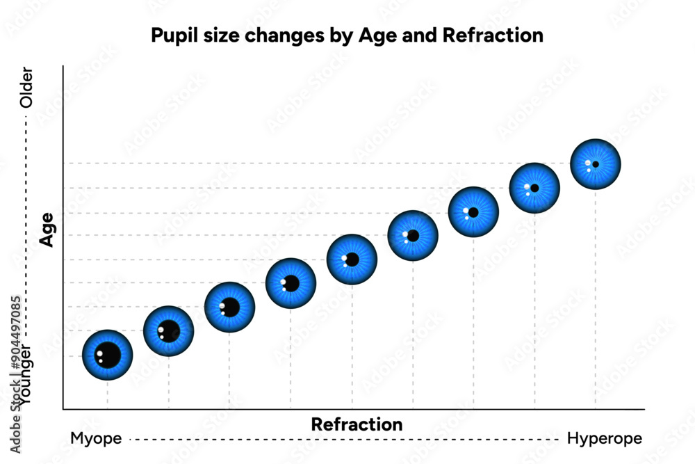 Pupil size changes by Refraction eye ophthalmology, medical diagram Stock Vector | Adobe Stock