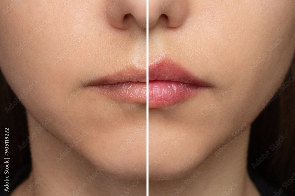 A young woman's lips before and after augmentation, front view. Comparison of thin, ugly lips ...