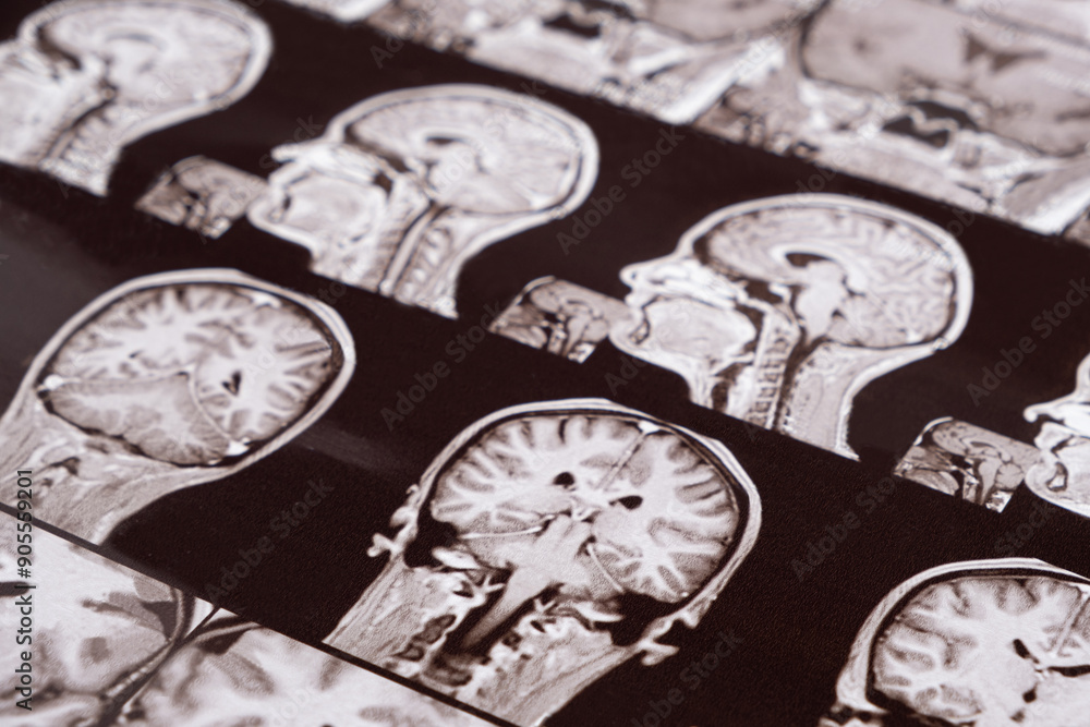 Póster Magnetic resonance imaging of the head of a healthy person ...