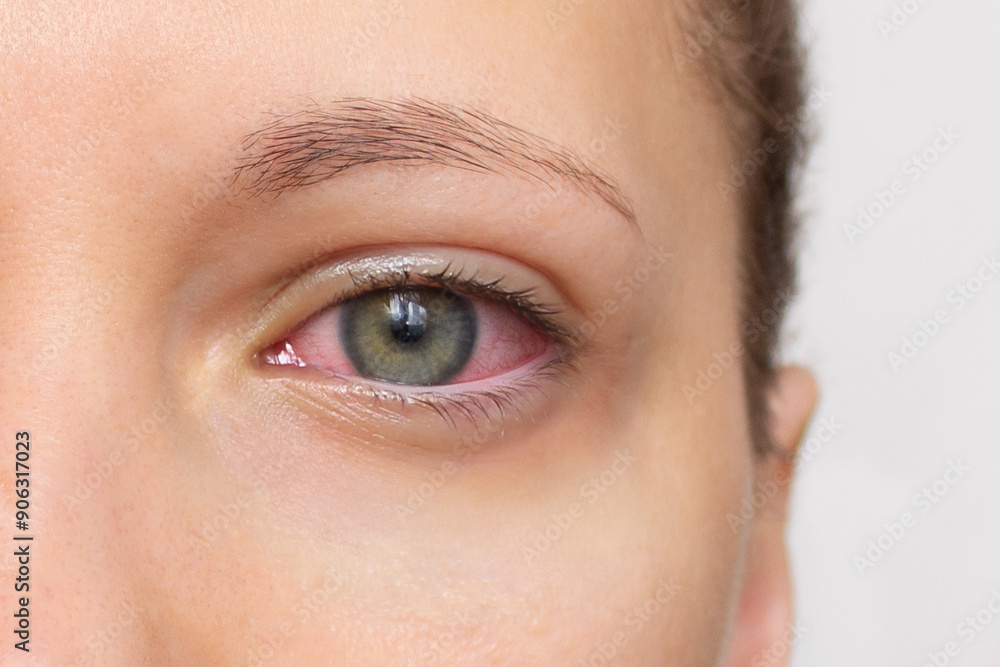 Close up of woman face with red eye. Swollen eyelids, irritation and ...