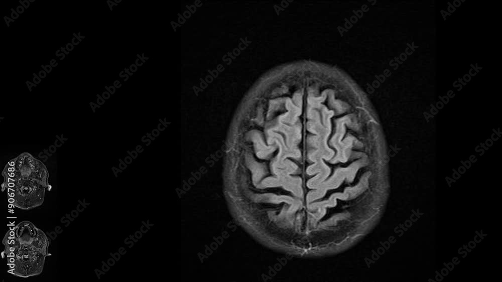 Magnetic resonance imaging of the brain. MRI of the brain. Medical examination of the human ...