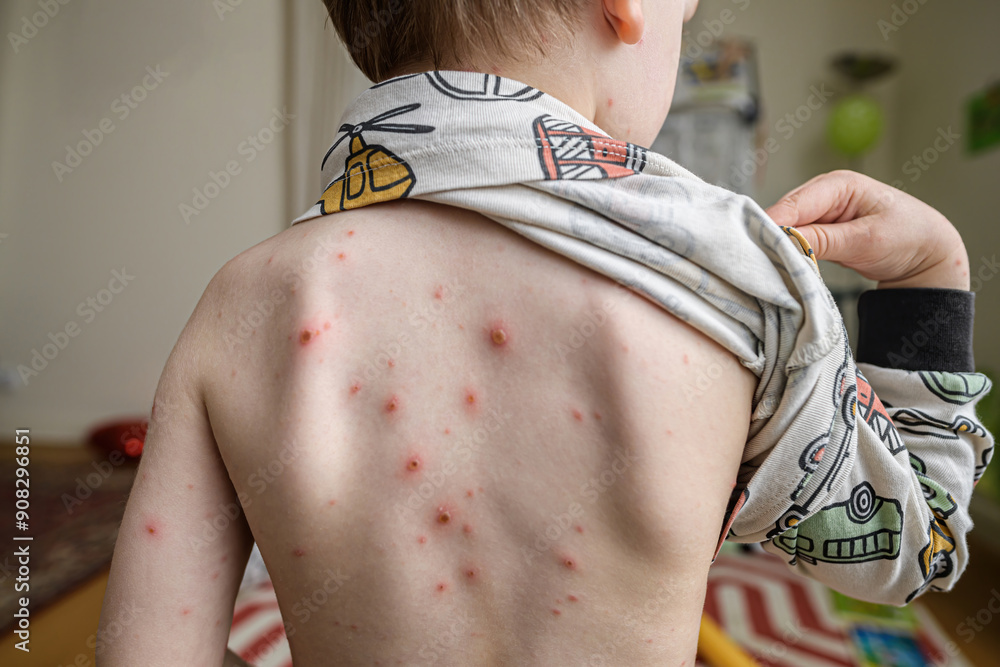 The back of a 4-year-old toddler covered by varicella (chickenpox ...