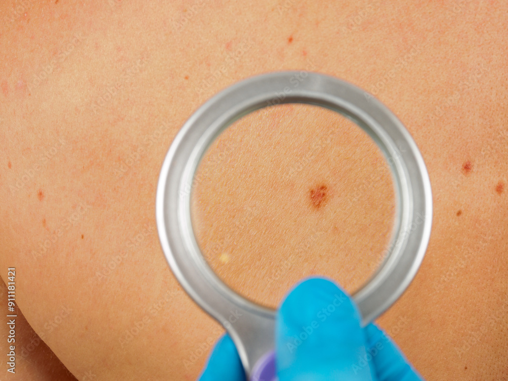 Skin examination by a dermatologist: examination of moles and ...