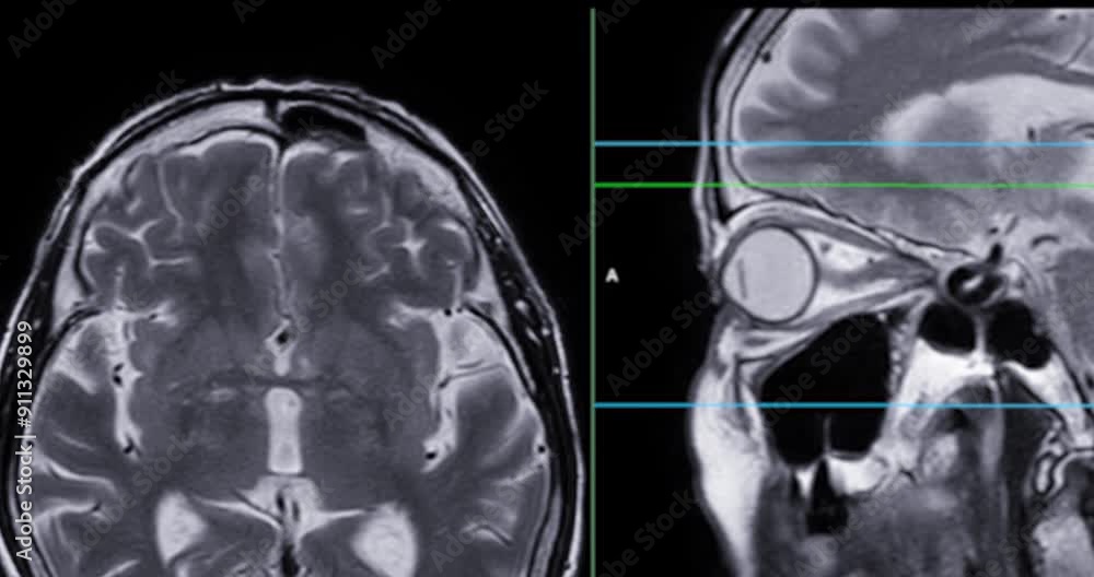 Footage of an MRI orbit scan in normal case displays comprehensive ...