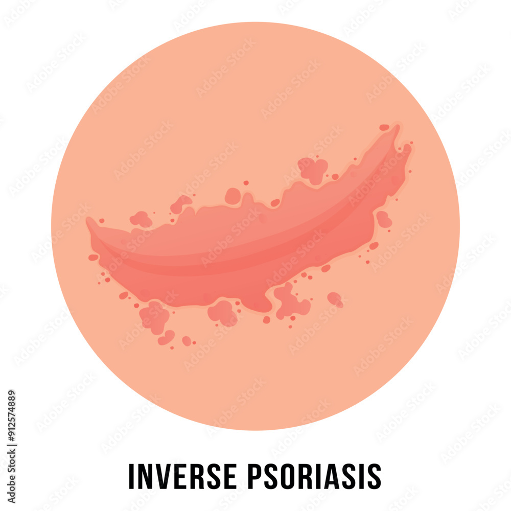 Illustration of inverse psoriasis with its appearance on the body Stock ...
