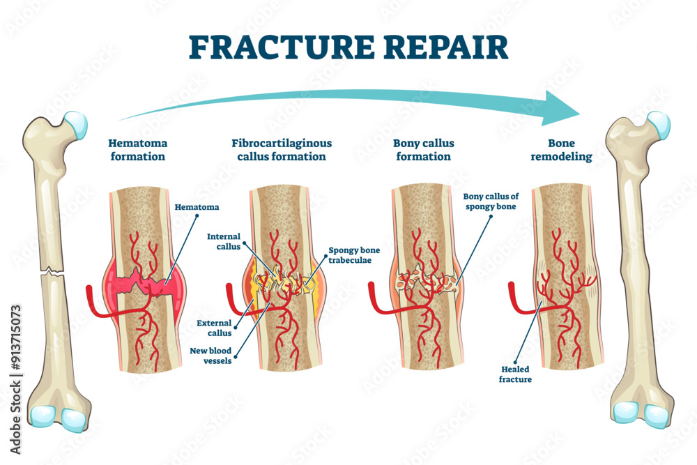 Fracture repair as educational bone remodeling and formation stages ...