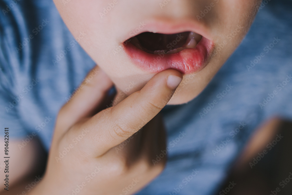 Child bit lip after anesthesia, painkiller after dentist appointment. Swollen lip. Anesthesia ...