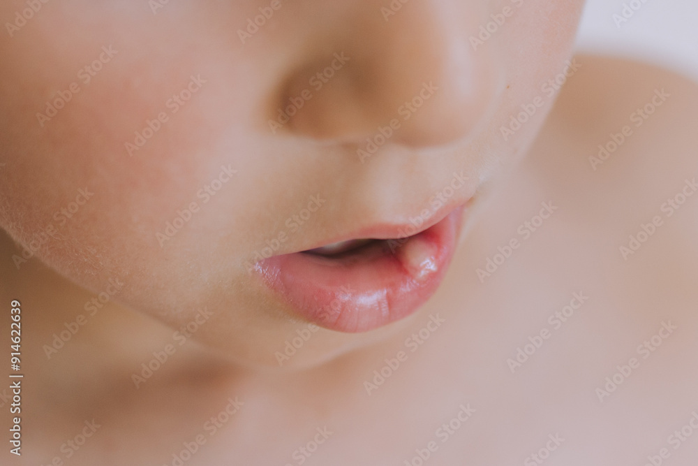 Child bit lip after anesthesia, painkiller after dentist appointment. Swollen lip. Anesthesia ...