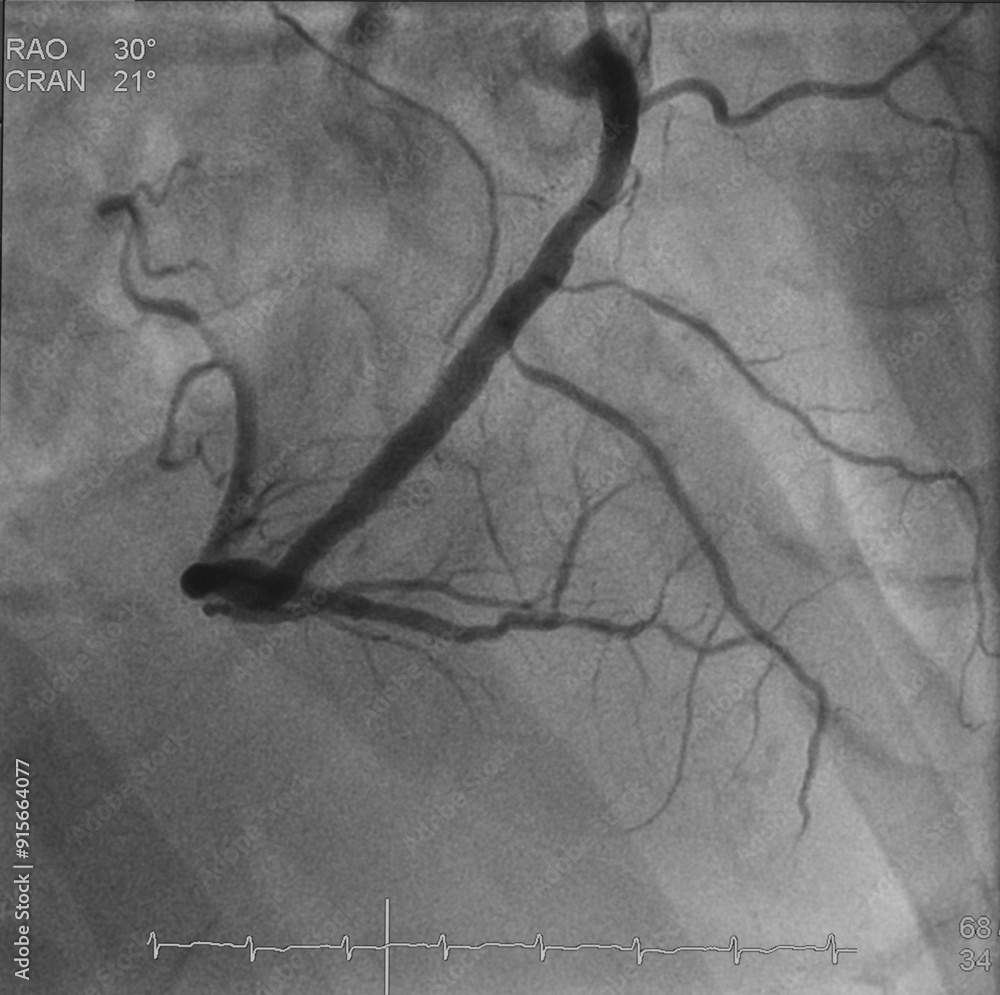 Coronary angiogram (CAG) was performed right coronary artery (RCA ...