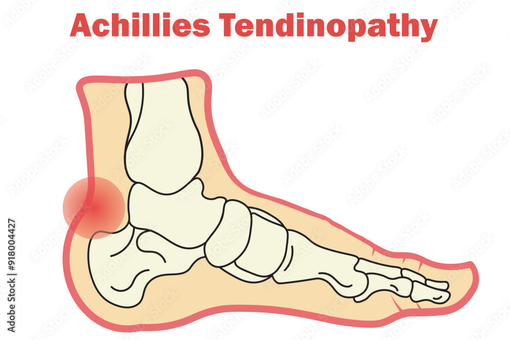 Achilles tendinopathy is a condition characterized by pain, stiffness ...