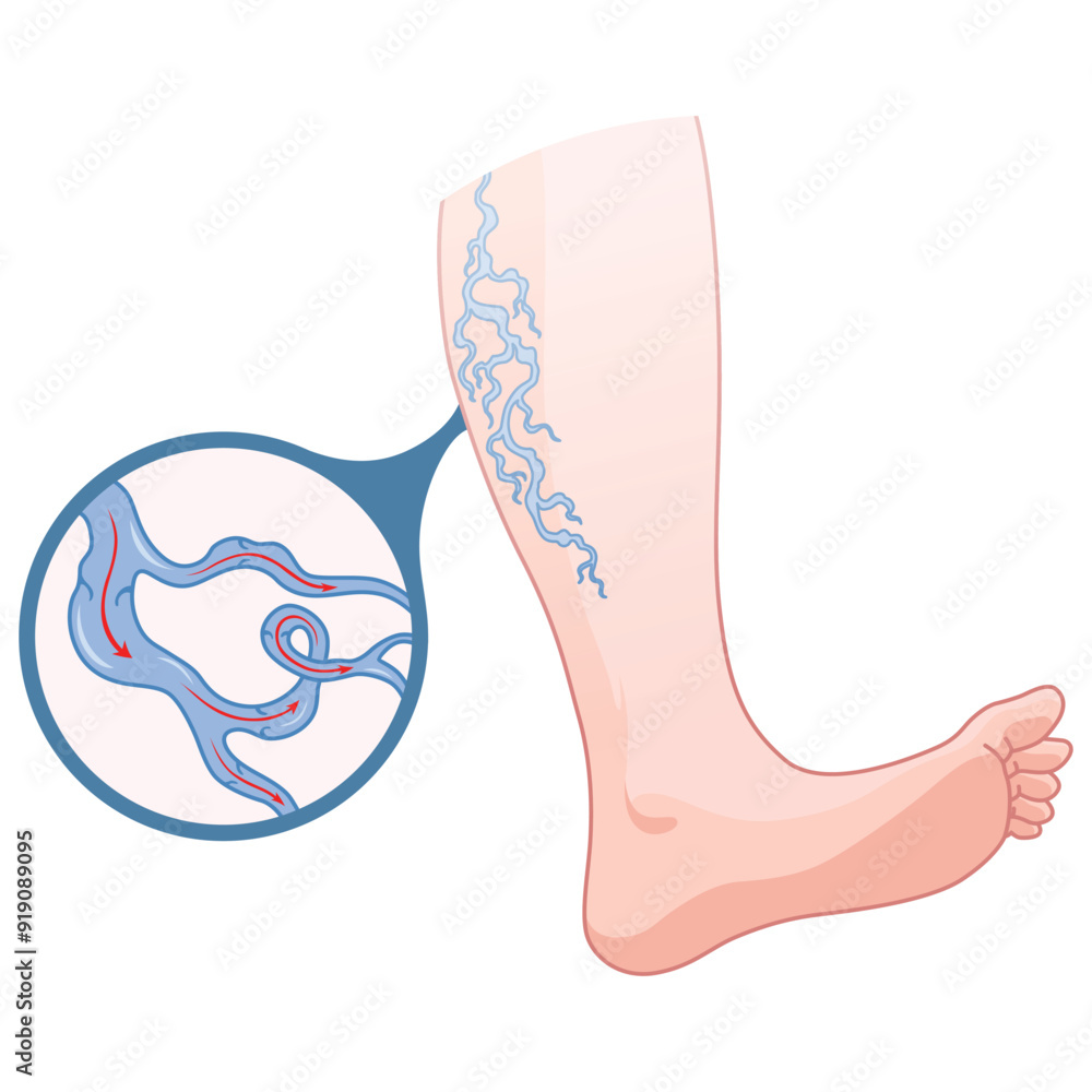 Varicose veins. Blue blood vessel visible through the skin, abnormally ...