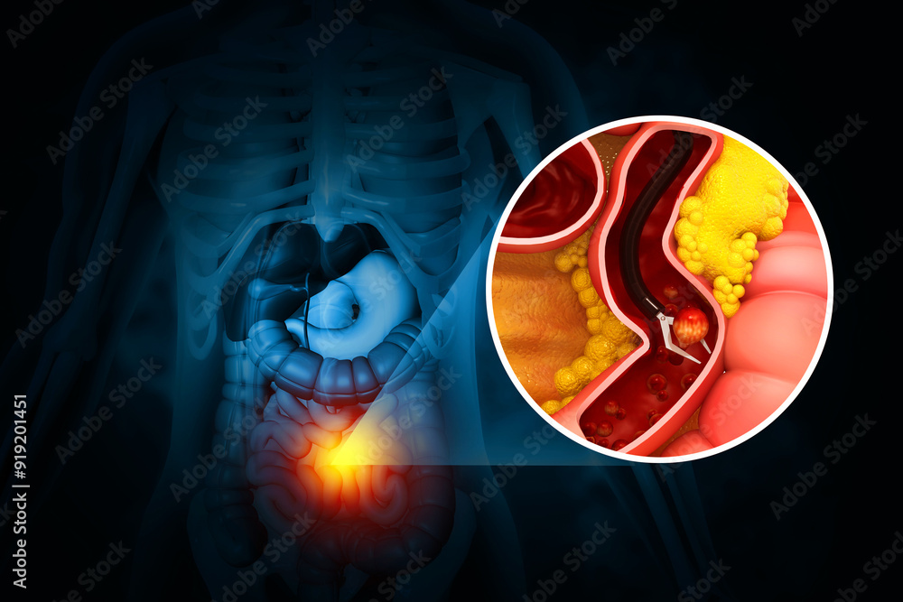 colon cancer. colonoscopy in the colon. polyp removal. 3d illustration ...