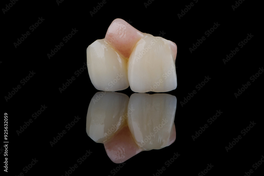Two dental crowns wit artificial gum made of zirconium for fixation to ...