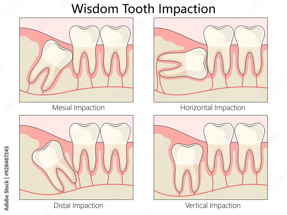 wisdom tooth impaction. mesial, horizontal, distal, and vertical ...