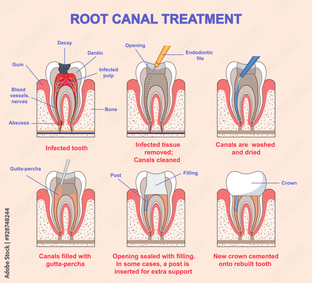 Root canal treatment. Medical infographic or diagram with stages of ...