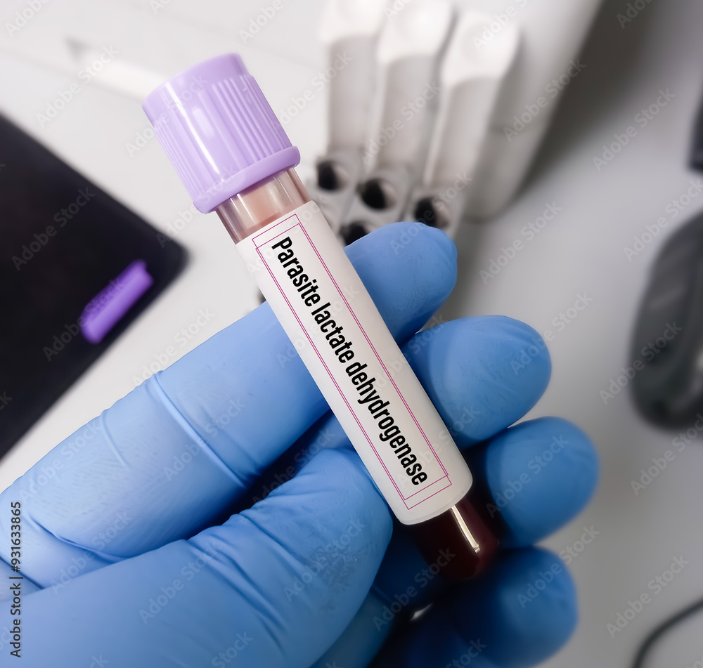 Blood test sample for mRDT or malaria rapid diagnostic test. Histidine ...