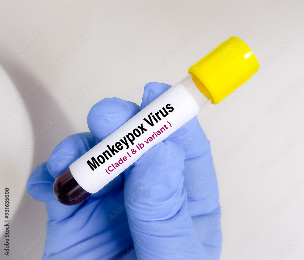 Blood test sample for monkey pox virus (MPXV) test. Mpox (formerly ...