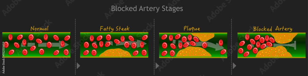 Blocked artery, blood vessels stages, atherosclerosis. Fatty steak ...