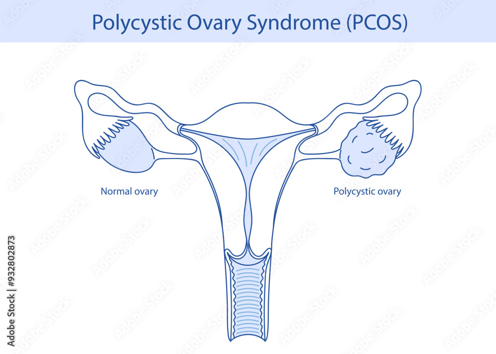 Polycystic ovary syndrome PCOS. Ovarian cysts of the female ...