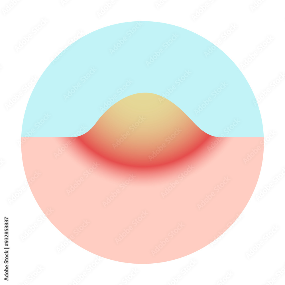 mpox, monkey pox disease. stage 4 pustule macule of Mpox skin symptom ...