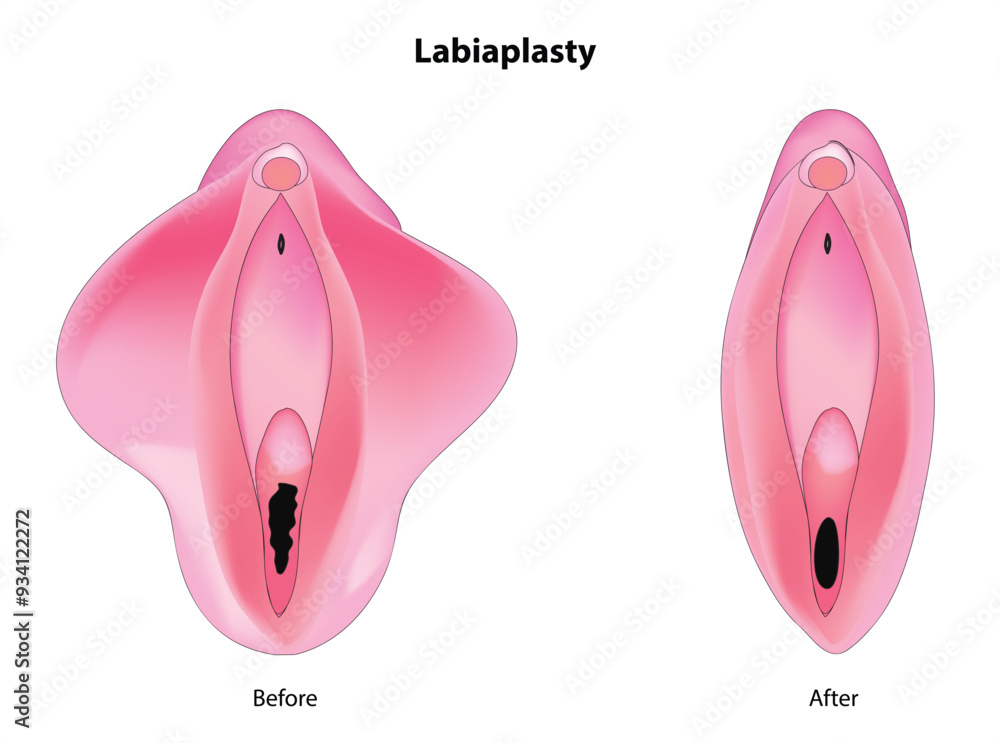 Labiaplasty Plastic Surgery Procedure For Creating Or Altering The