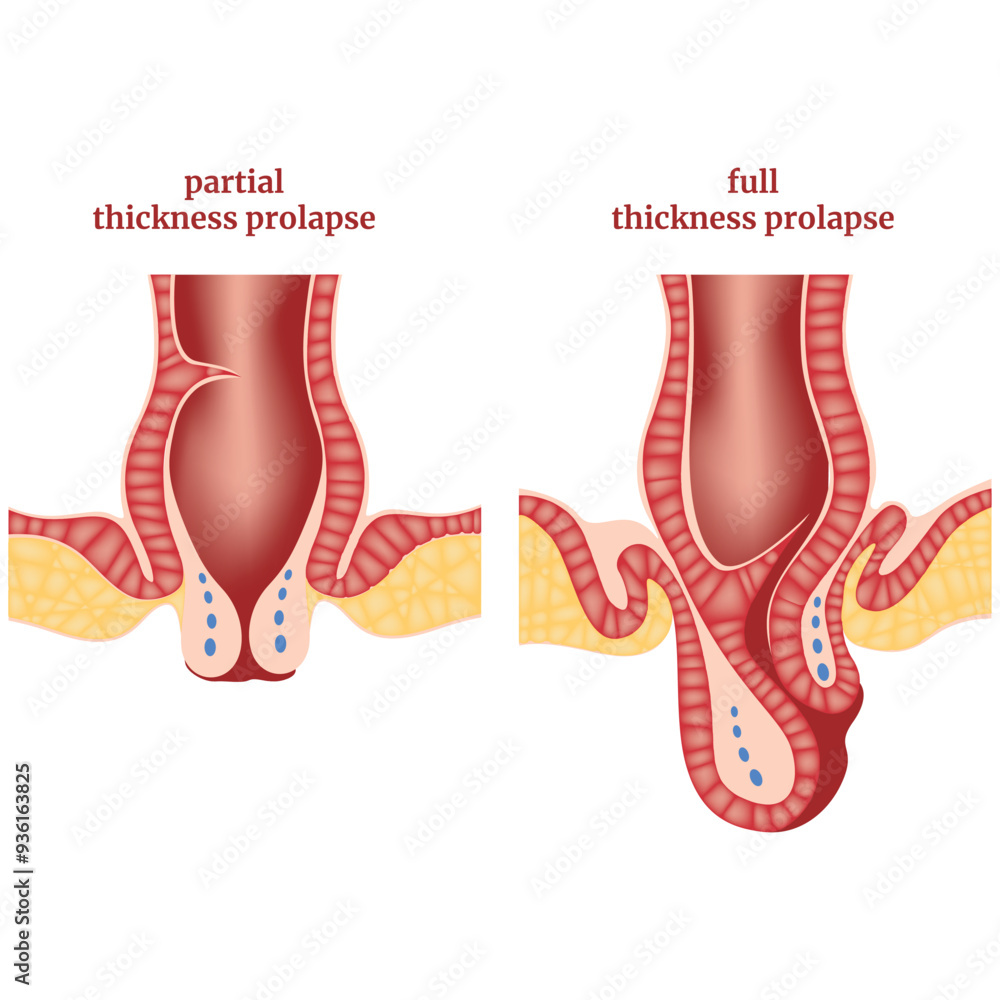 Anal prolapse, hemorrhoids. Diagram, scheme with the disease. Medical ...