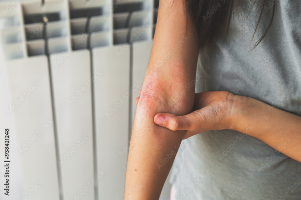 a girl shows her combed dry skin on the bend of her elbow, redness ...