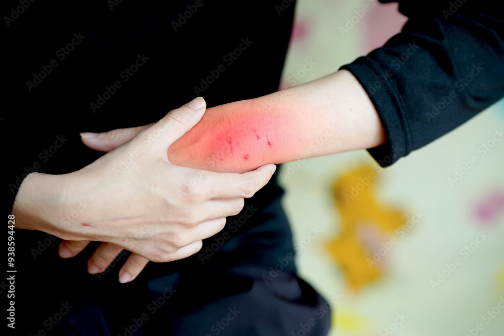 Person showing irritated skin on arm, rubbing the reddened and bruised ...