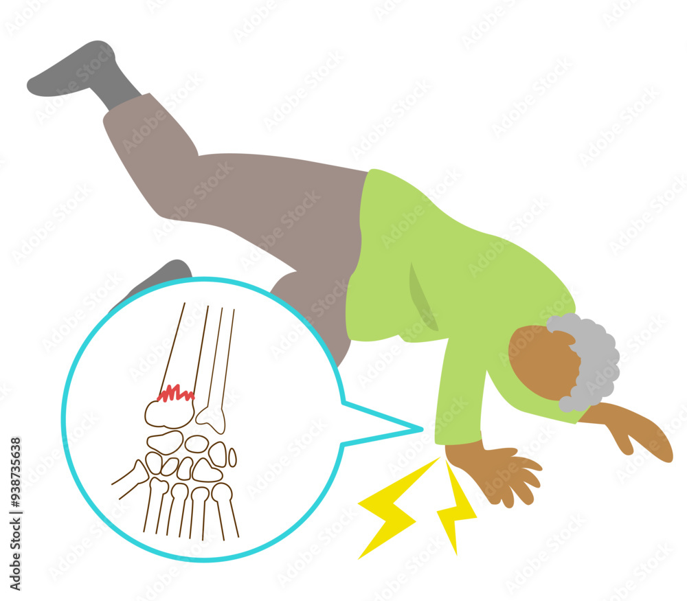 Preferred sites of fall fractures in the elderly due to osteoporosis ...