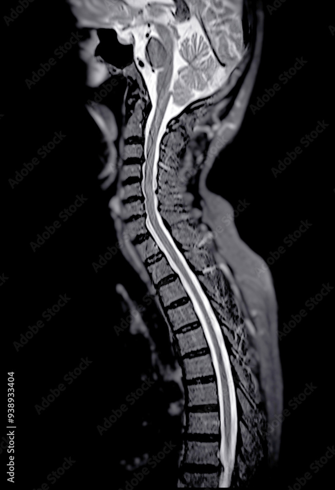 MRI of C-spine or magnetic resonance image of cervical spine sagittal ...