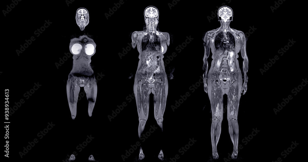 MRI whole body scans are beneficial for early cancer detection, monitoring chronic conditions ...