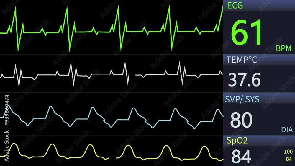 Animated video of a patient monitor screen displaying vital sign values ...