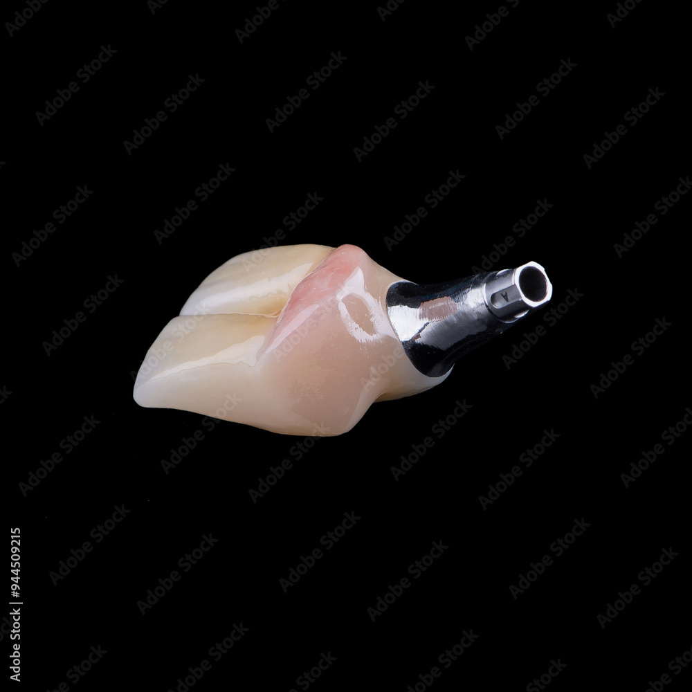 Two dental crowns with artificial gum made of zirconium on titanium ...