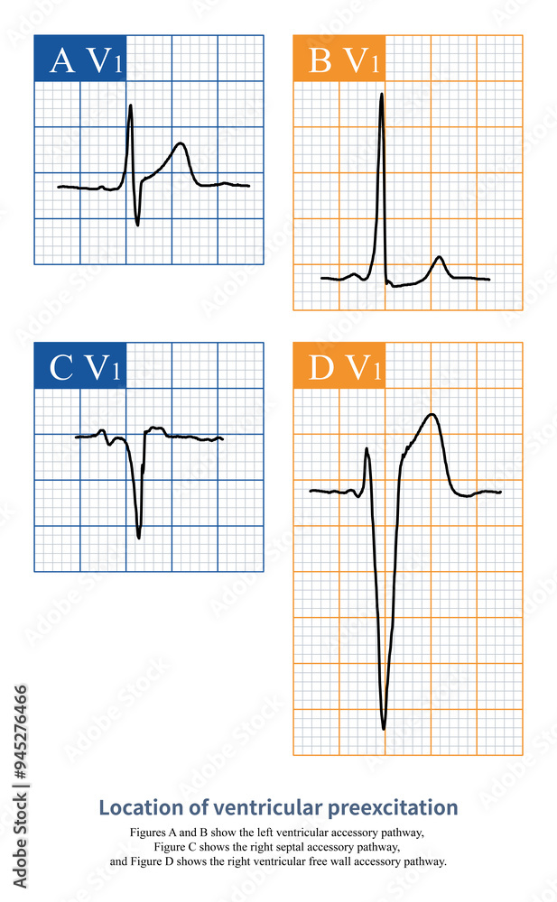 Poster On the electrocardiogram, observing the morphology of QRS waves ...